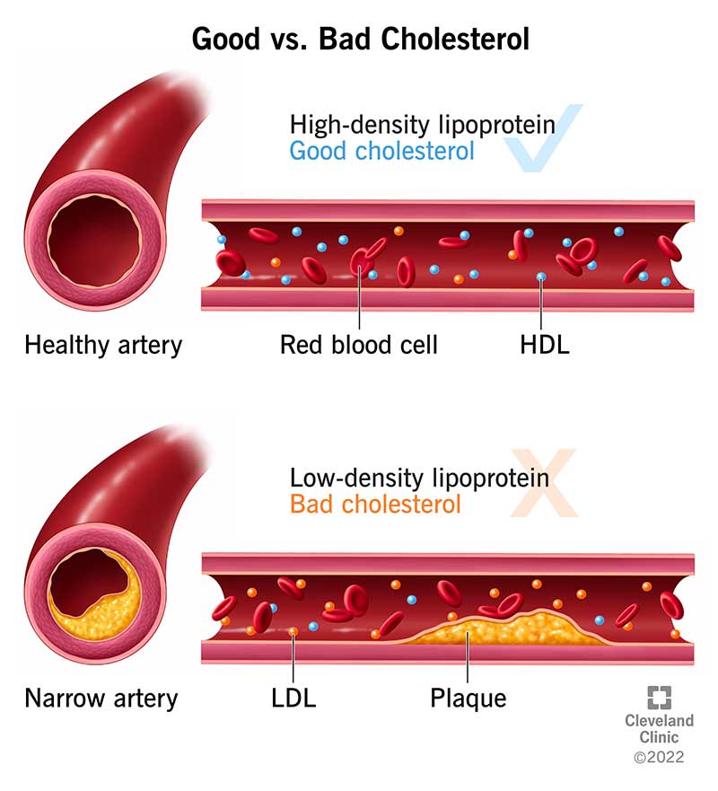 Understanding Cholesterol: Symptoms & Causes | Lowering High ...