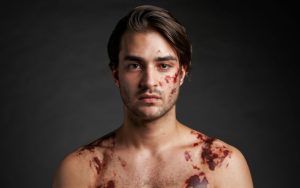 Beyond the Bump: Understanding Bruises and When to Worry